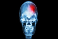 Brain Contusion Imaging: Practice Essentials, Computed Tomography ...
