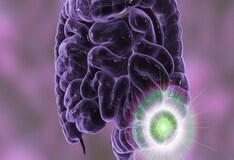 Colon Cancer Imaging: Practice Essentials, Radiography, Computed Tomography