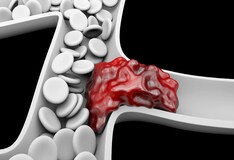 Acute Pulmonary Embolism (Helical CT): Overview, Radiography, Computed ...