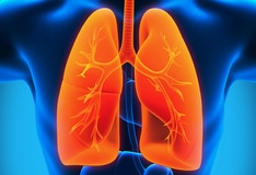 Idiopathic Pulmonary Fibrosis Imaging: Practice Essentials, Radiography ...