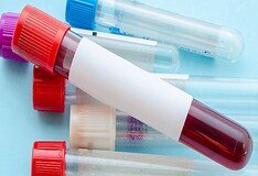 Antinuclear Antibody: Reference Range, Interpretation, Collection and ...