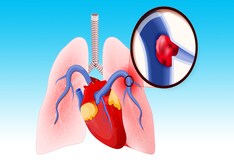 Pulmonary Embolism: Practice Essentials, Background, Anatomy