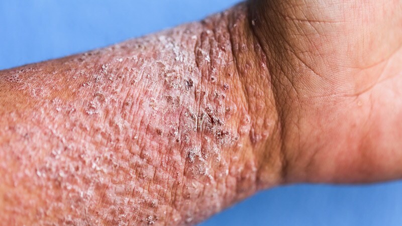 Atopic Dermatitis | Medscape