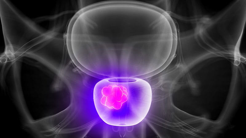 GU/Prostate Cancer | Medscape