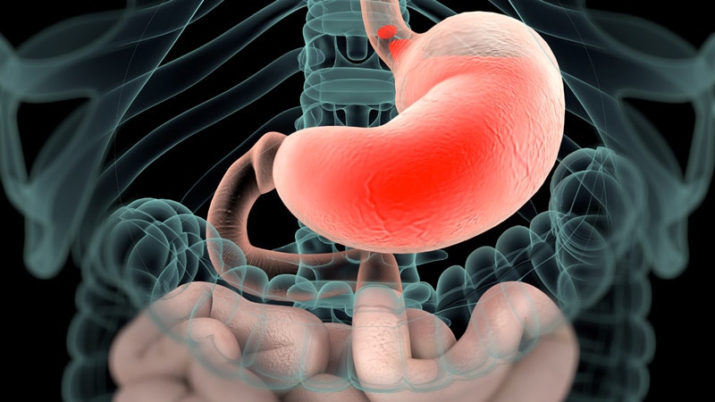 Minimally Invasive Gastrointestinal Surgery | Medscape