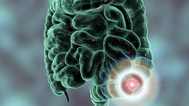 GI/Colorectal Cancer | Medscape