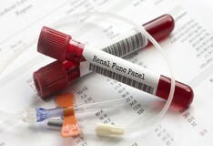 Direct Antiglobulin Testing: Overview, Clinical Indications ...