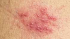 Herpes Zoster Differential Diagnoses