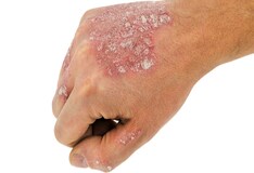 Psoriasis Guidelines: Guidelines Summary