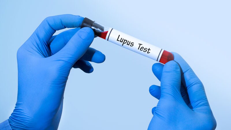 Systemic Lupus Erythematosus | Medscape