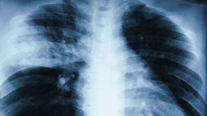 Asthma | Medscape