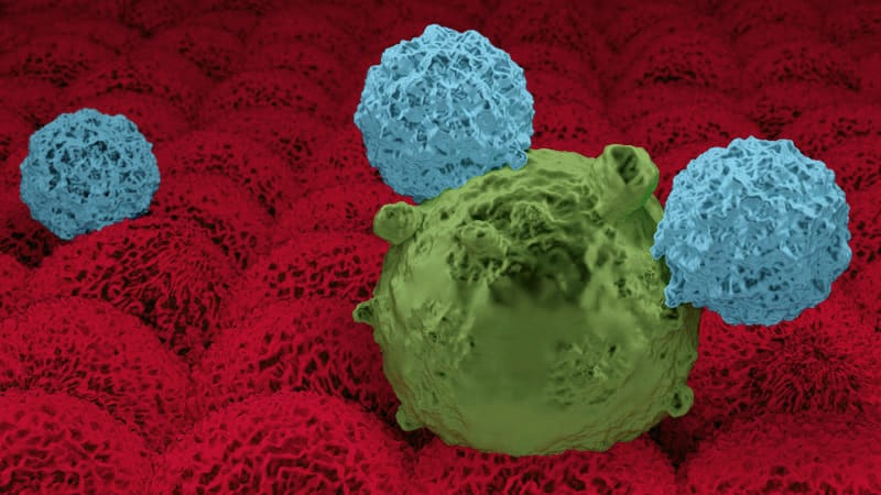 Multiple Myeloma | Medscape