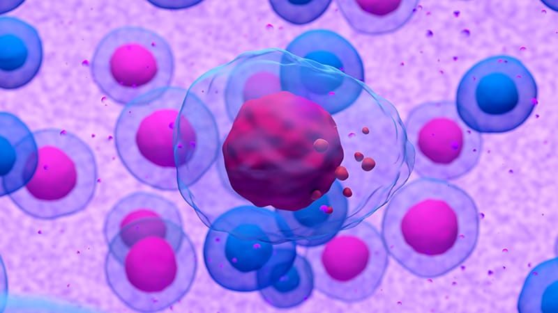 Multiple Myeloma | Medscape