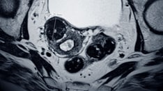 Antidepressants Linked to Postpartum Hemorrhage