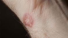 cryptococcus infection skin