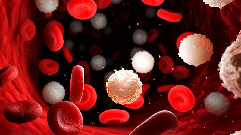 Acute Leukemia | Medscape