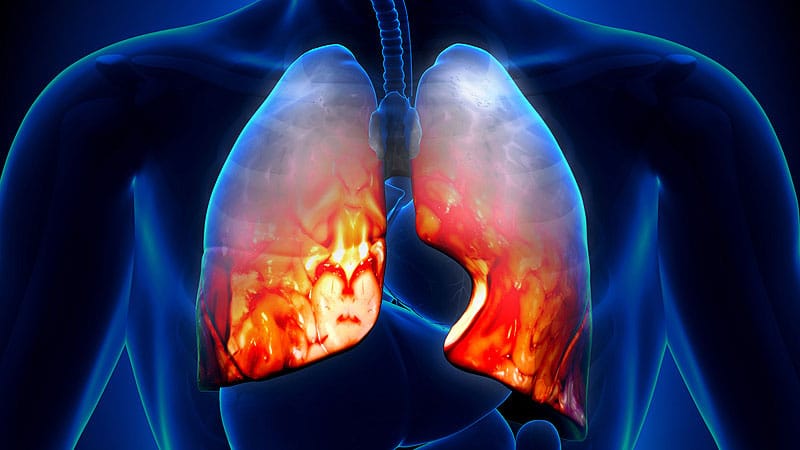 Pneumonia | Medscape