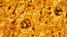 Alzheimer Disease Imaging: Practice Essentials, Computed Tomography, Magnetic Resonance Imaging