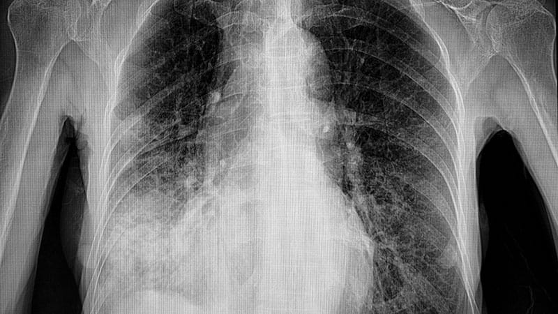 Pneumonia | Medscape