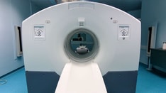 Giant Cell Arteritis (Temporal Arteritis) Workup: Approach ...