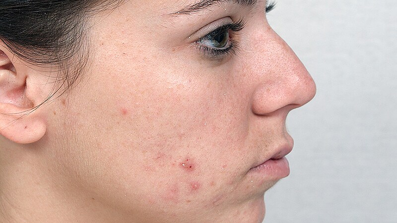 Acne | Medscape