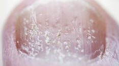 Plaque Psoriasis: Practice Essentials, Background, Pathophysiology