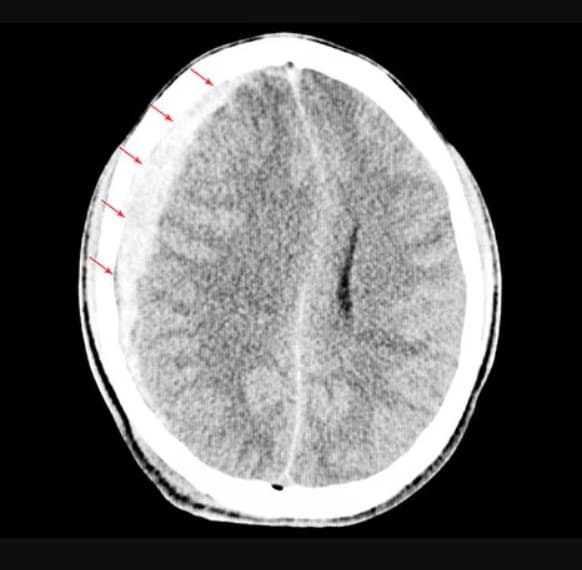 A 72-Year-Old Woman Is Found at the Bottom of a Staircase