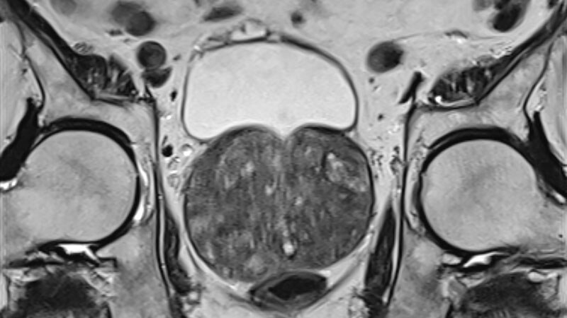 Benign Prostatic Hyperplasia (BPH) | Medscape
