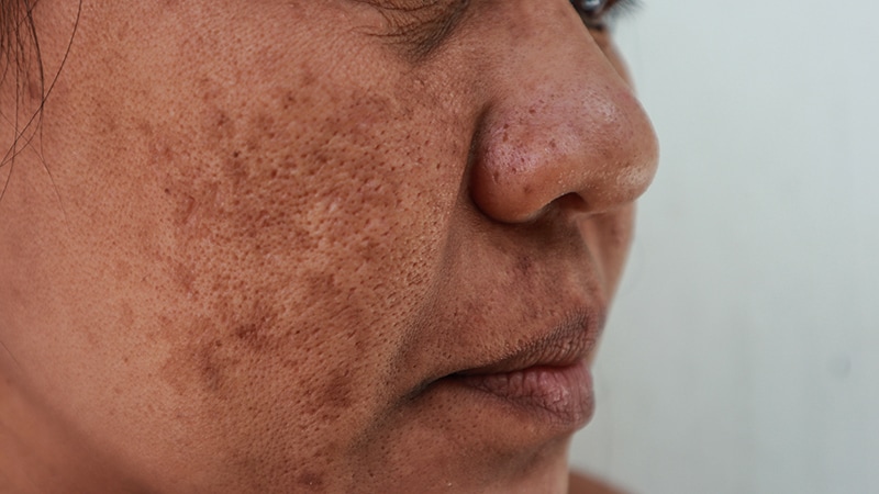 Skin Cancer | Medscape