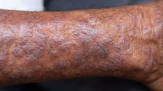 Atopic Dermatitis Differential Diagnoses