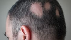 Litfulo (ritlecitinib) dosing, indications, interactions, adverse ...