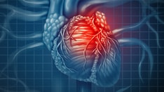 Myocardial Infarction Treatment & Management: Approach Considerations ...