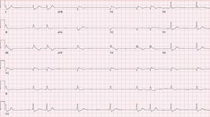 ATNAA, DuoDote (atropine-pralidoxime) dosing, indications, interactions ...