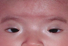 A Baby With Droopy Eyelids