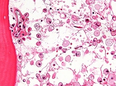 Cerdelga (eliglustat) dosing, indications, interactions, adverse ...