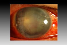 B-Scan Ocular Ultrasound: Overview, Indications for Examination ...