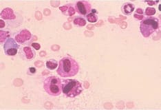 Systemic Mastocytosis Treatment & Management: Medical Care, Surgical ...