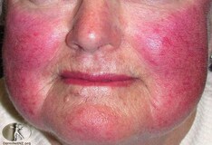 Rosacea: Practice Essentials, Background, Pathophysiology