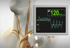 Esophagogastric Devascularization Technique: Sugiura Procedure ...