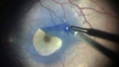 TissueBlue (brilliant blue G ophthalmic) dosing, indications ...