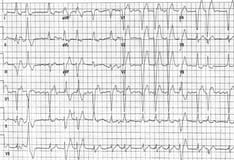 Brugada Syndrome: Practice Essentials, Background, Pathophysiology