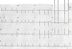 Sinus Bradycardia Workup: Laboratory Studies, Imaging Studies