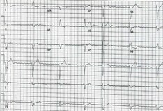 Pediatric Right Bundle Branch Block: Background, Pathophysiology, Etiology