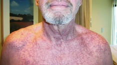 vectibix side effects