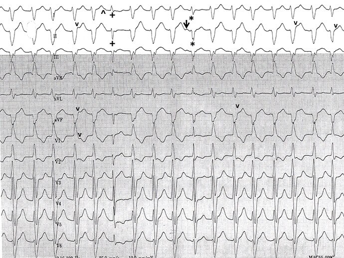 ECG Challenge: Sudden Palpitations and Shortness of Breath - Page 2