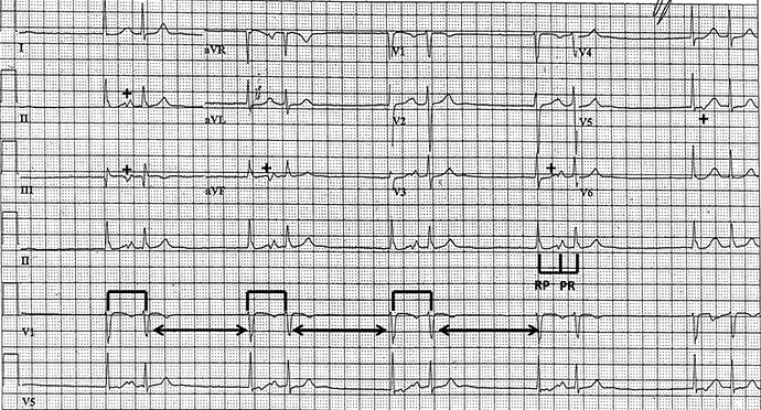 ECG Challenge: Irregular Pulse During Cardiology Visit - Page 2