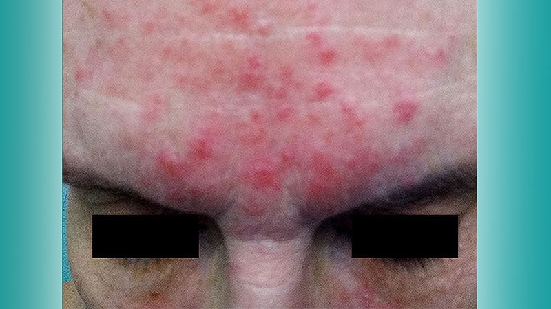 Pediatric Dermatology | Medscape