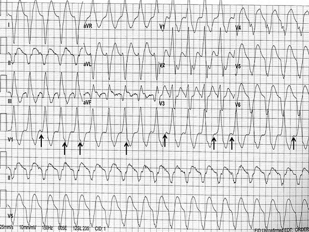 ECG Challenge: AF Patient With Lightheadedness, Rapid Pulse - Page 2