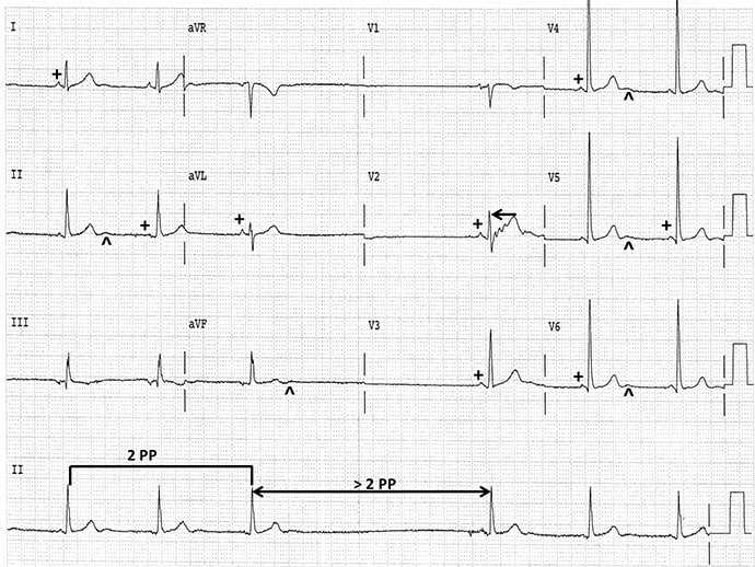 ECG Challenge: What's Causing This Long Pause? - Page 2