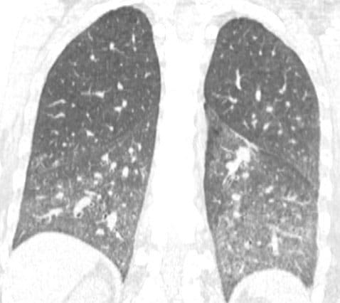 A Truck Driver With Progressive Dyspnea and Cough - Page 4